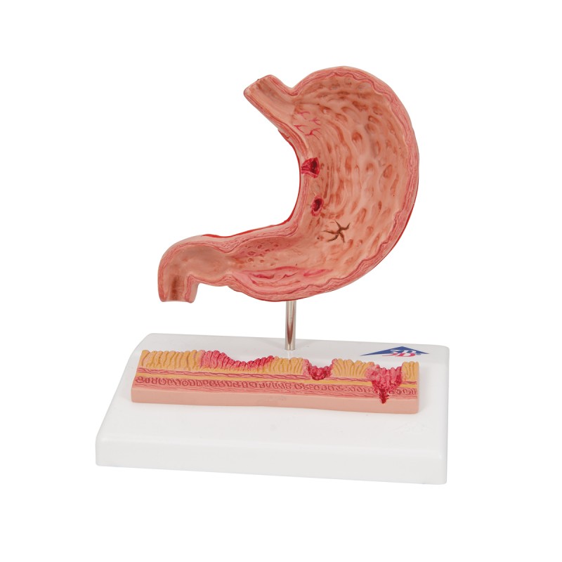 anatomisch model van de maag met maagzweer, dunnedarmzweer en een ...